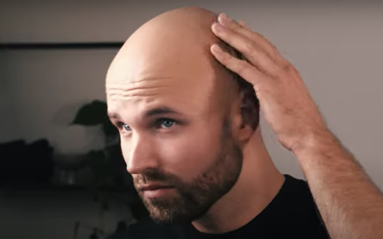 "Manje uspješni i nezadovoljni životom" Evo šta žene misle o ćelavim ...