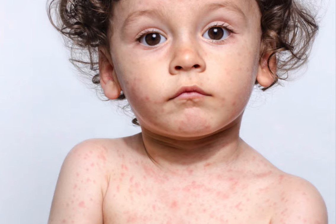 Morbile i dalje aktivne u vazduhu, u Srpskoj 44 slučaja oboljelih