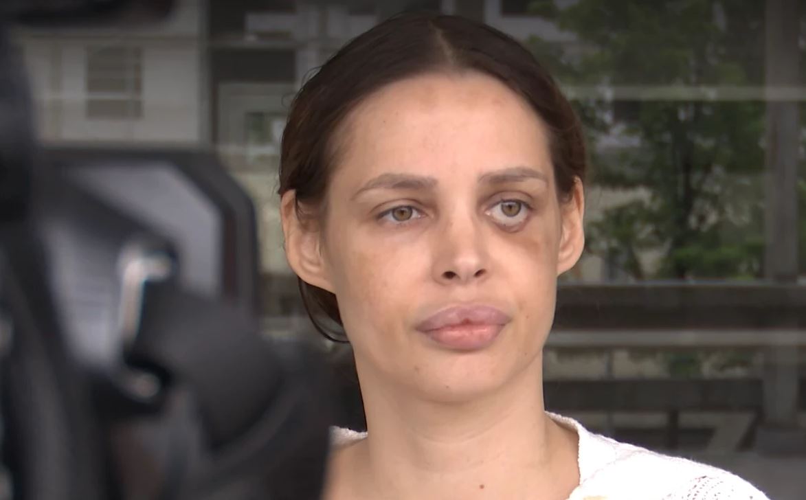 Nataša Šavija ponovo pretučena, objavila fotografije jezivnih povreda